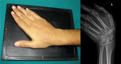 Ulnar Deviation X Ray