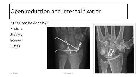 Scahpoid Fracture And Its Physiotherapy Management Pptx