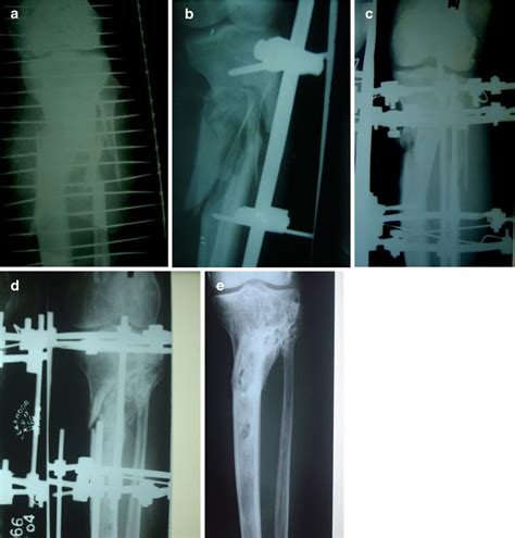 A Initial Anteroposterior Ap Radiograph Shows A Comminuted Fracture