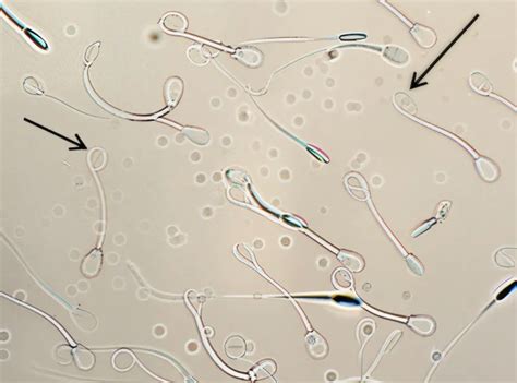Hypo Osmotic Swelling Test Host In Semen Evaluation