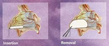 Clinical Practice Guidelines Epistaxis