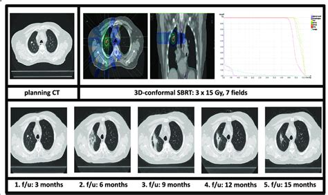 Treatment Planning With Dose Volume Histogram Ptv And Oars And Download Scientific Diagram