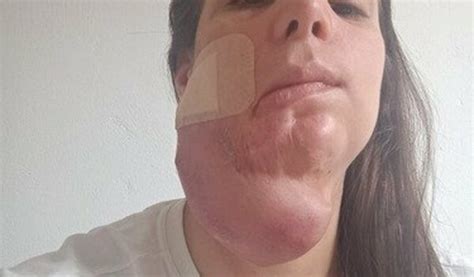 Queimadura 3 Grau No Rosto Vaquinhas Online