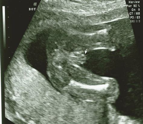 Difference Between Ultrasound And Sonogram Mgmtreka