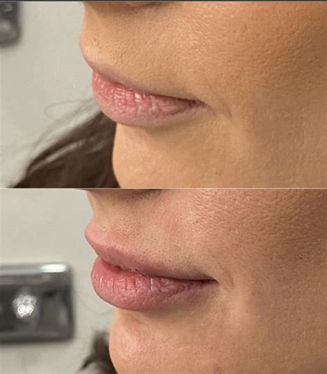 Dr Tamar Filler ტუჩის კორექცია ან მოცულობის გაზრდა