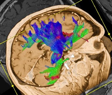 Radiopaedia Case Diffusion Tensor Imaging And Tractography Of The