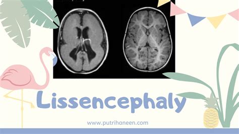 Mengenal Lissencephaly Smooth Brain Putri Haneen