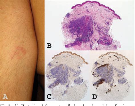Figure 2 From Primary Cutaneous Marginal Zone Bcell Lymphoma With Anetoderma Spontaneous