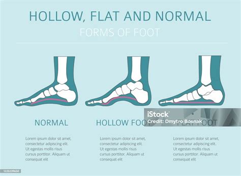 발 변형 유형 의료 Desease 인포 그래픽 중공 평평하고 정상적인 발 발에 대한 스톡 벡터 아트 및 기타 이미지 발