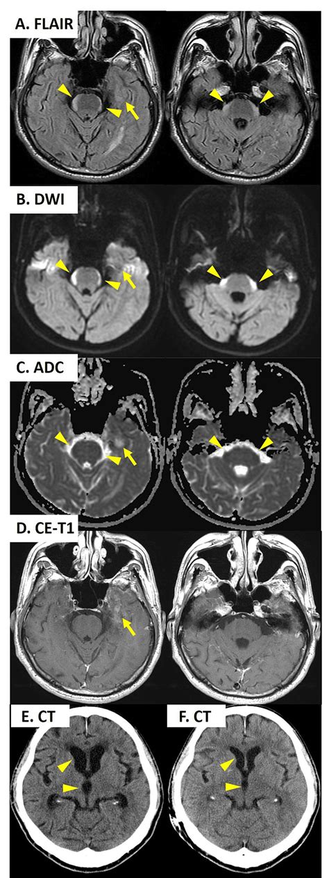 Brain Magnetic Resonance Imaging Mri Findings A Fluid Attenuation Download Scientific