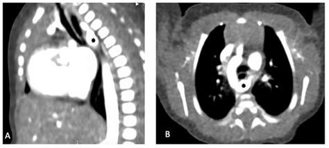 Fetal Atrial Flutter Early Detection And Treatment Auctores