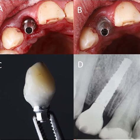 A Abutment Placement B Adding F Lowable Composite Around The Download Scientific Diagram