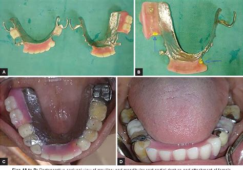 Maxillary Removable Partial Denture