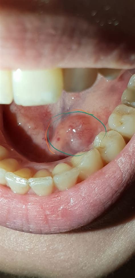 Как выглядит стоматит под языком фото