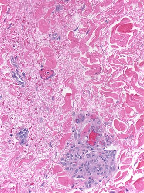 Angiosarcoma Mgh Learn Pathology