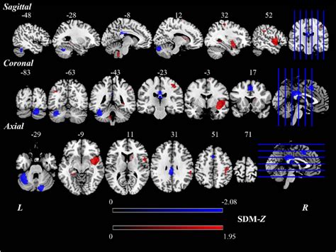 Brain Regions Showing Significant Differences Of Regional Spontaneous Download Scientific