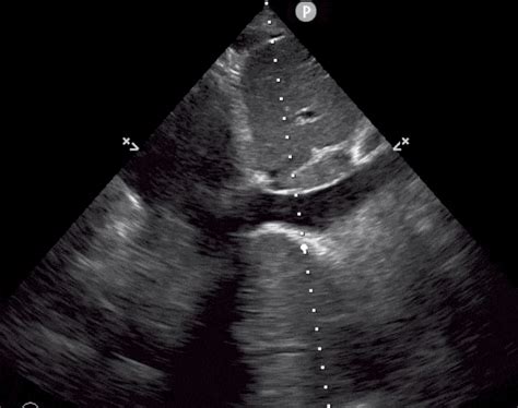 Cardiac Ultrasound Echocardiography Made Easy Step By Step Guide