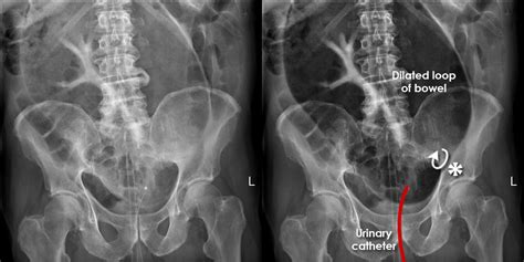 Abdominal X Ray Abnormalities Sigmoid Volvulus