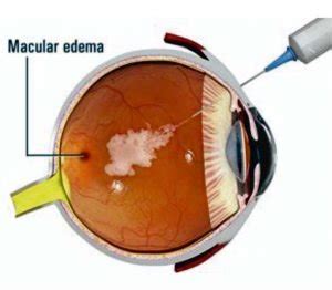 Intravitreal Injection The Stoneygate Eye Hospital Leicester