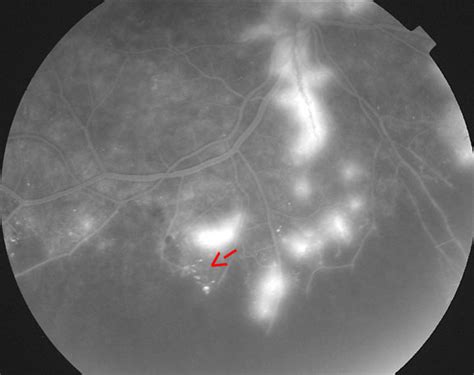 Neovascularization Elsewhere