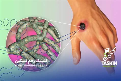 کلینیک زخم تسکین مشهد درمان انواع زخم بستر، دیابتی و مزمن