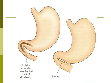 Peptic Ulcer Disease Pptx Duodenum Ulcer Ppt