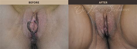 Labioplasty Horia Siclovan