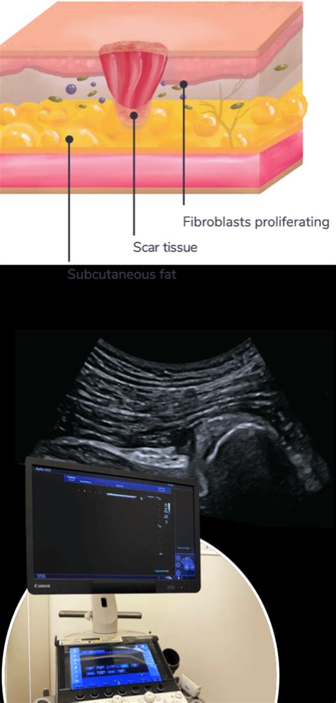 Shockwave Therapy For Scar Tissue