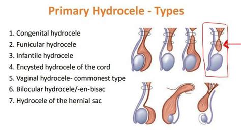Hydrocele Of The Cord