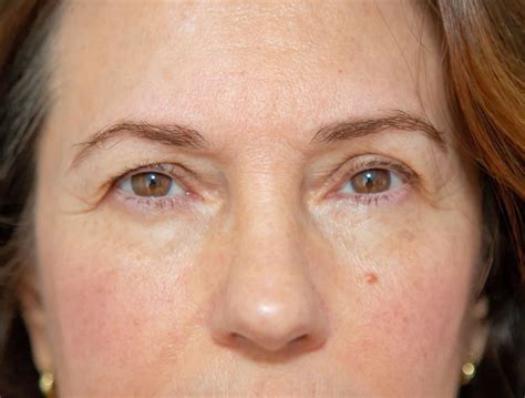 Blepharospasm Causes Symptoms And Treatment Options