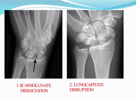 Carpal Instability And Perilunate Dislocation Pptx