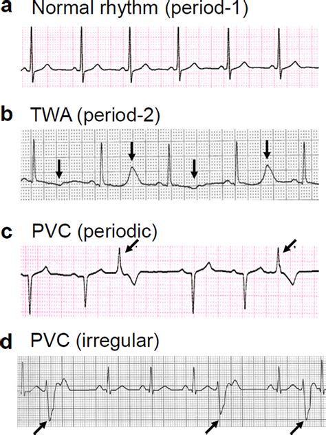 Nonlinear And Stochastic Dynamics In The Heart Pmc