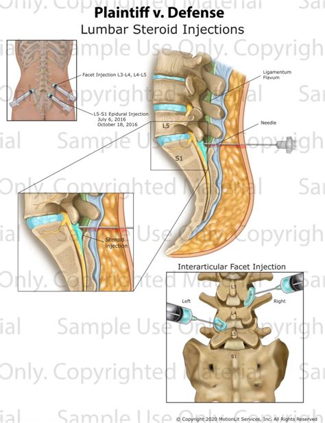 Epidural Injection S1 Motionlit