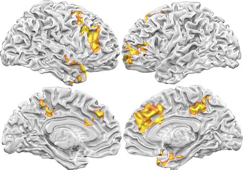 Regions Of The Brain For Which Person To Person Variability In Activity
