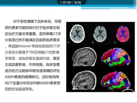 别黎教授基于三维建模定量分析脑灰白质密度差异评估急性硬膜下血肿转归 脑医汇