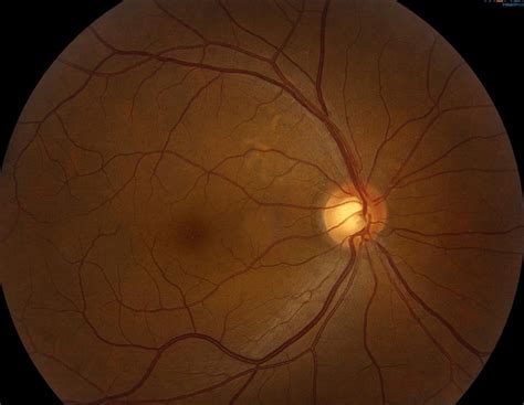 Focal Choroidal Excavation Fce What Is It