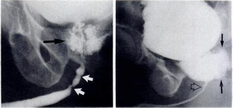 1 Prostatic Ducts A Retrograde Study Shows Reflux Of Contrast