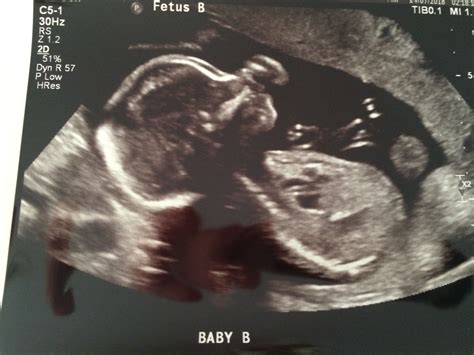 20 Weeks Pregnant With Triplets