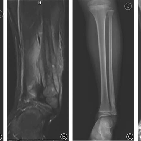 Preoperative Radiographic Examination Of Patient A X‐ray Before Download Scientific Diagram