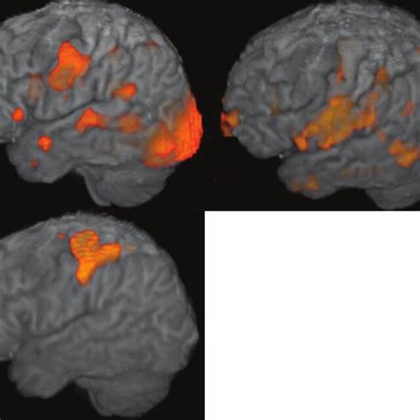 Preoperative Functional Magnetic Resonance Imaging Fmri During Download Scientific Diagram