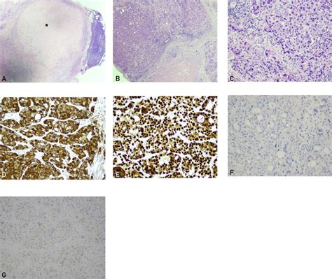 Follow Up Surgical Excision Of A Level II Cervical Lymph Node A C Download Scientific Diagram