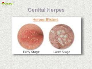 Genital Herpes Pptx