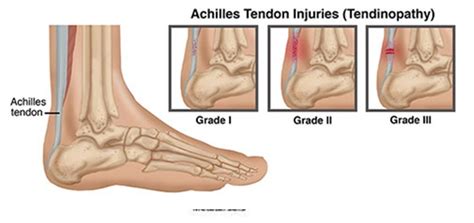 Achilles Tendonitis Vasta Performance Training And Physical Therapy
