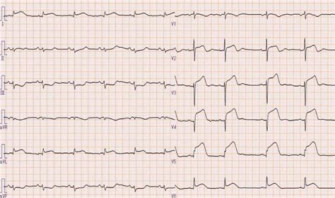 Twelve Lead Electrocardiogram Shows St Segment Elevation In I Avl And Download Scientific