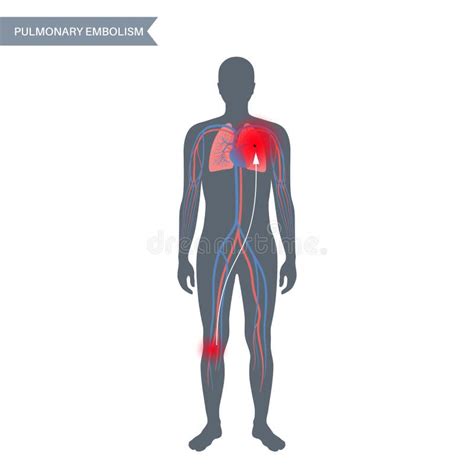 Pulmonary Embolism Disease Stock Vector Illustration Of Artery 255267928