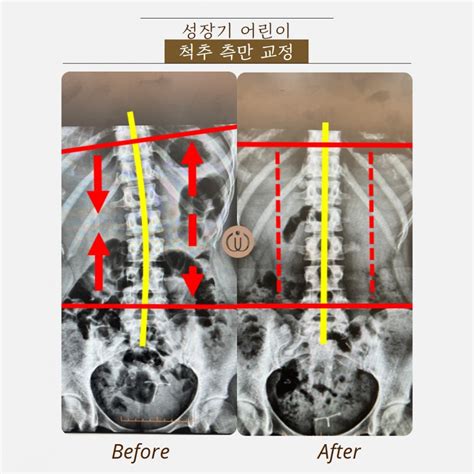 어스필라테스 허리 성장기 어린이 척추측만 교정