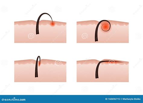 Ingrown Hairs After Epilation Stock Vector Illustration Of Epidermis