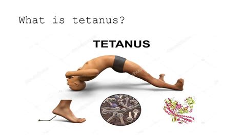 Tetanus Symptoms Prevention Treatment PPT