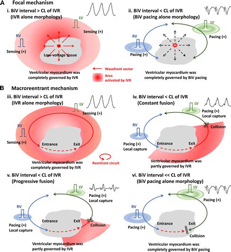Continuous Resetting Of Reentrant Idioventricular Rhythm With