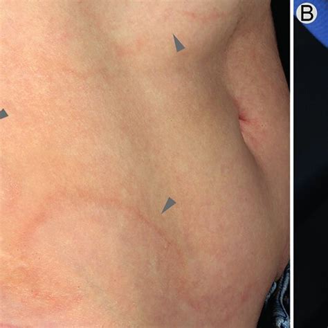 A Hypopigmented Large Macules On The Lower Abdomen With An Elevated